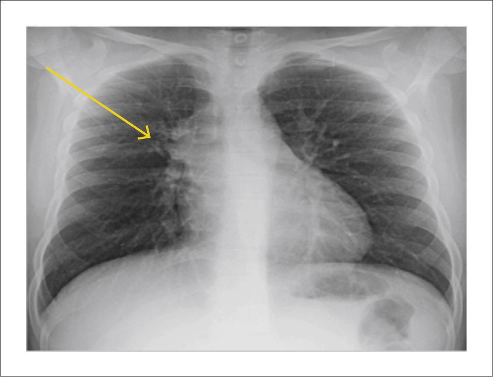 LA TUBERCULOSIS EN EL NIÑO, ¿CÓMO SE DIAGNOSTICA? | Revista Médica ...