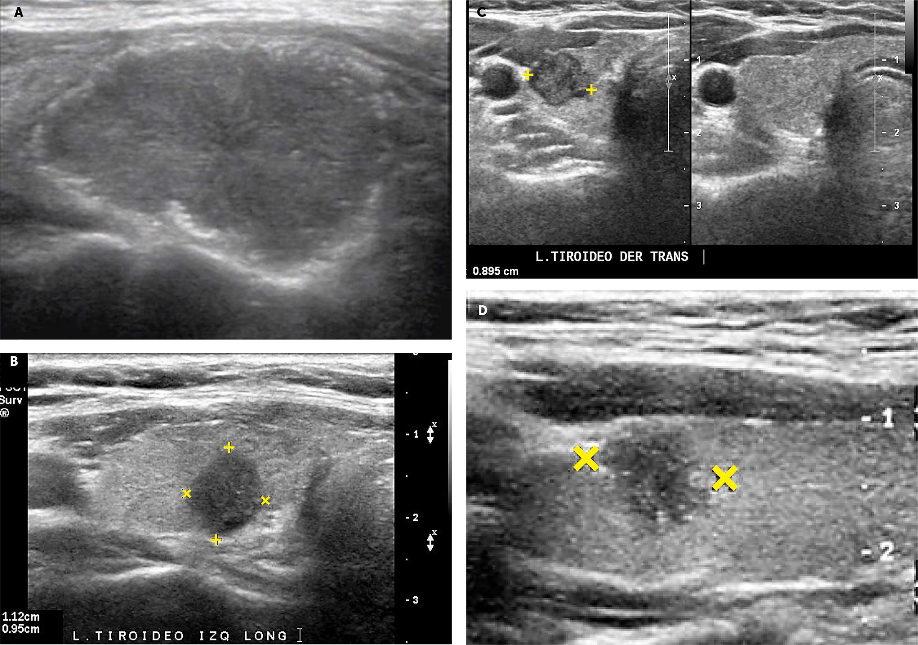 Ecografía de tiroides | Revista Médica Clínica Las Condes
