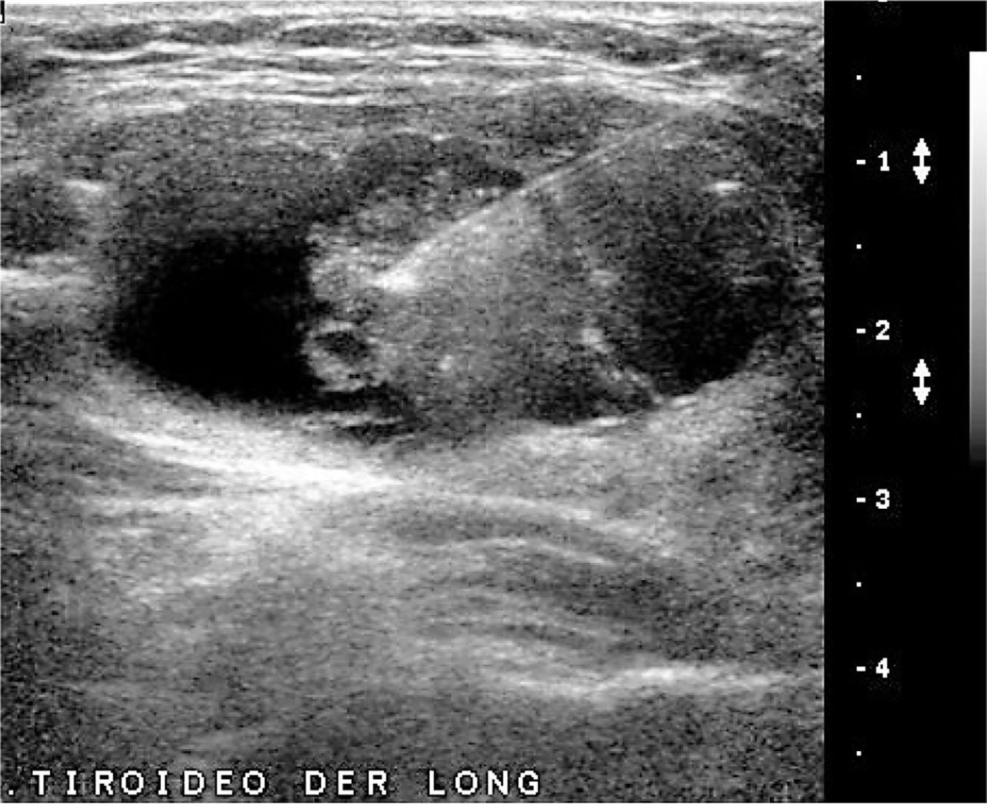 Ecografía de tiroides | Revista Médica Clínica Las Condes