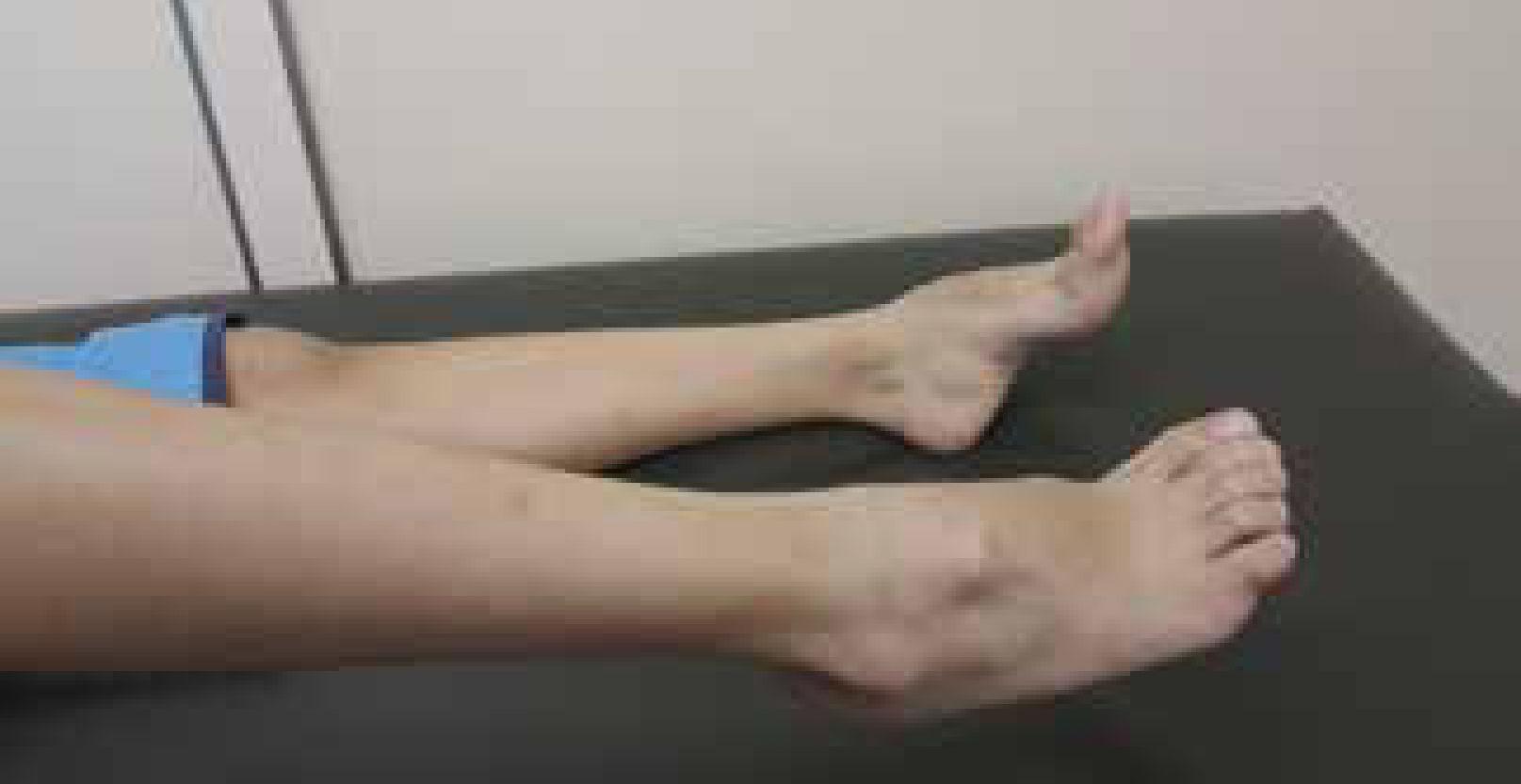 Evolution Of Charcot–Marie–Tooth Disease Type 1A, 43% OFF