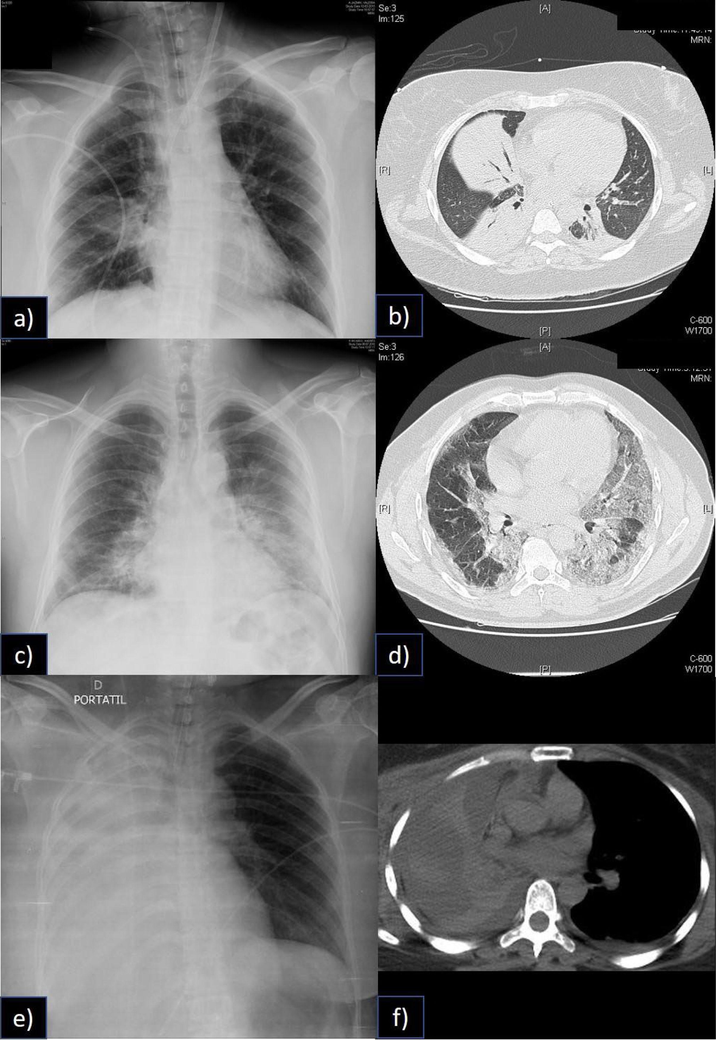 ¿QUÉ HEMOS APRENDIDO DE FALLA RESPIRATORIA CATASTRÓFICA? | Revista ...