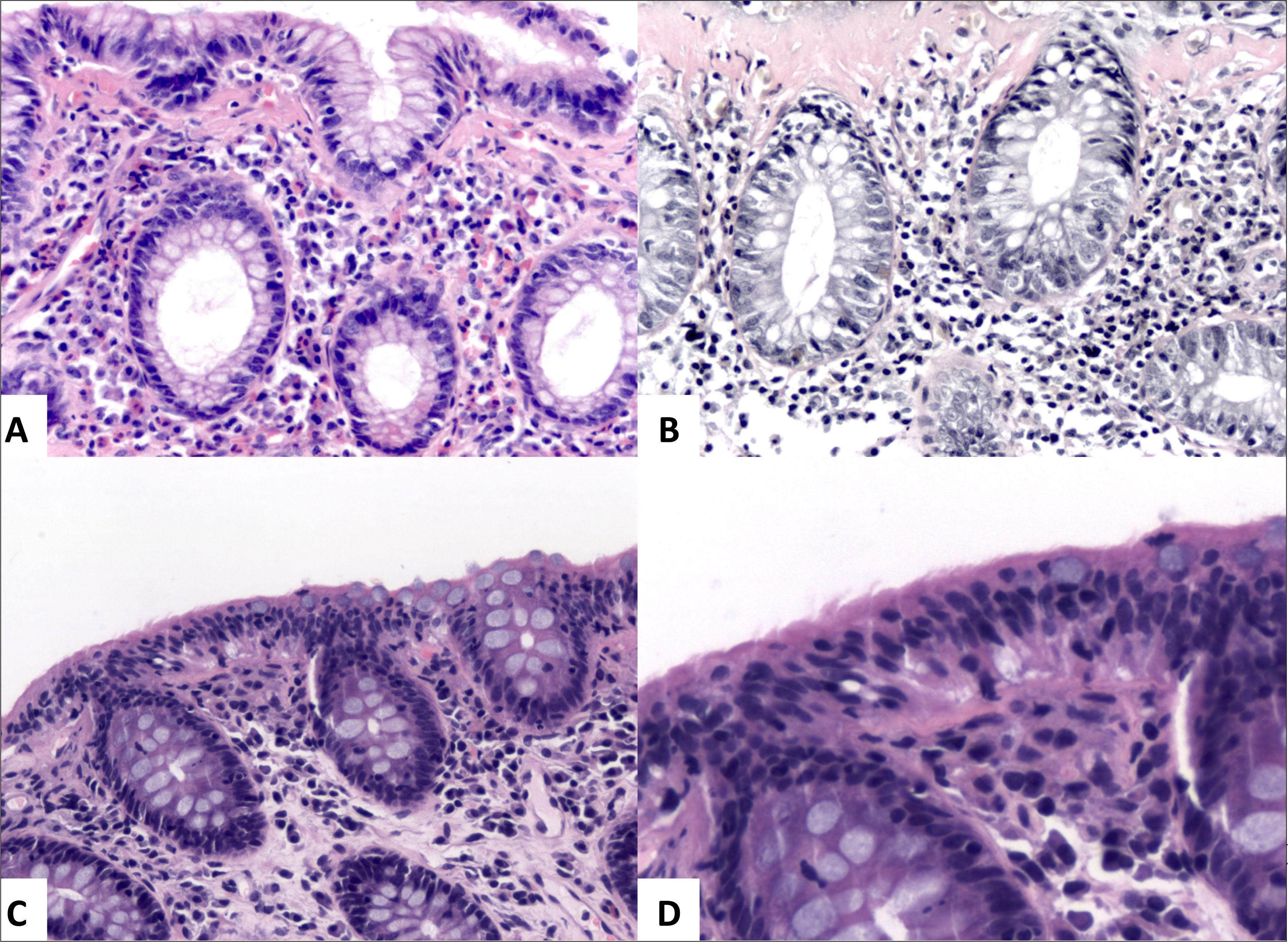 Histología en la Enfermedad Inflamatoria Intestinal | Revista Médica ...