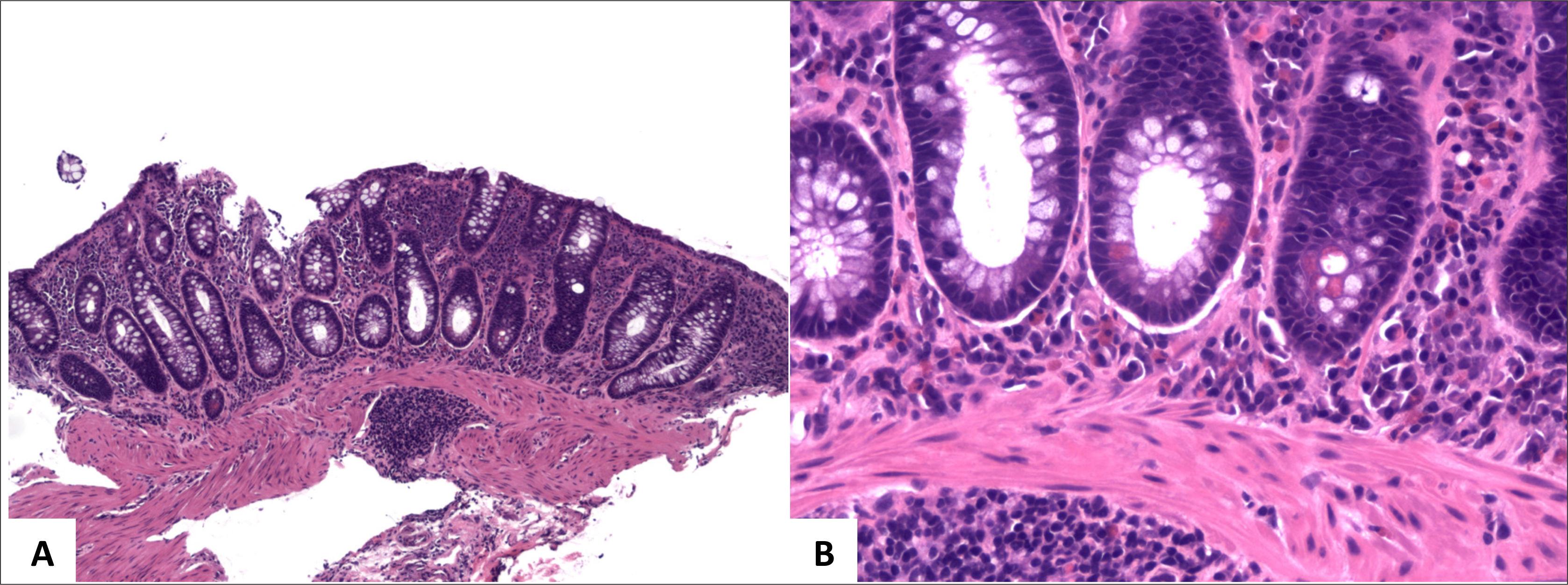 Histología en la Enfermedad Inflamatoria Intestinal | Revista Médica ...
