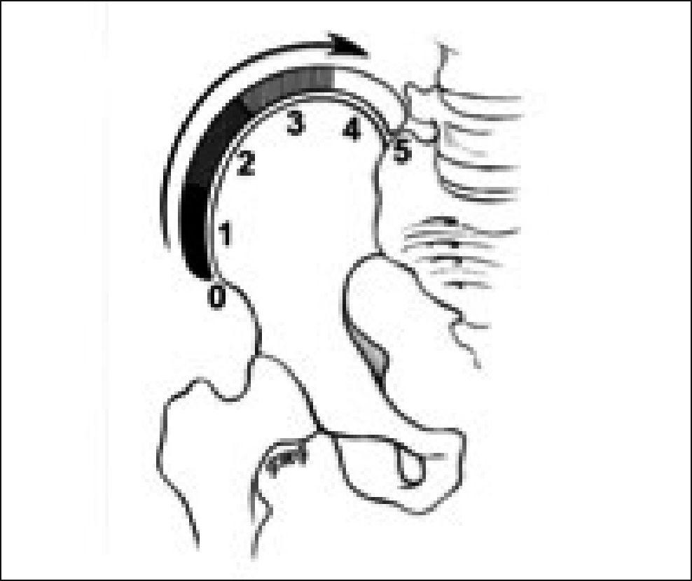 ESCOLIOSIS IDIOPÁTICA DEL ADOLESCENTE DE BAJO GRADO | Revista Médica ...