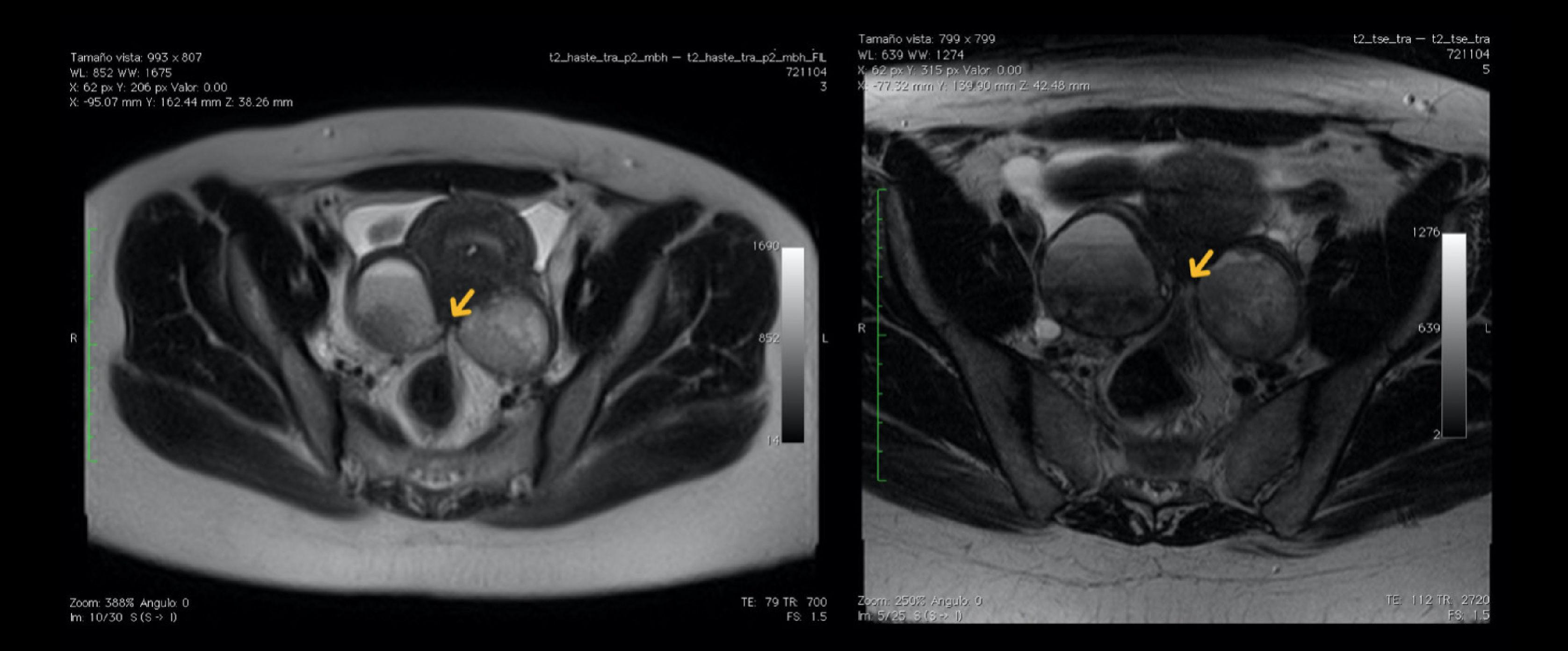 Resonancia magnética en el estudio de dos pacientes con dolor pélvico ...