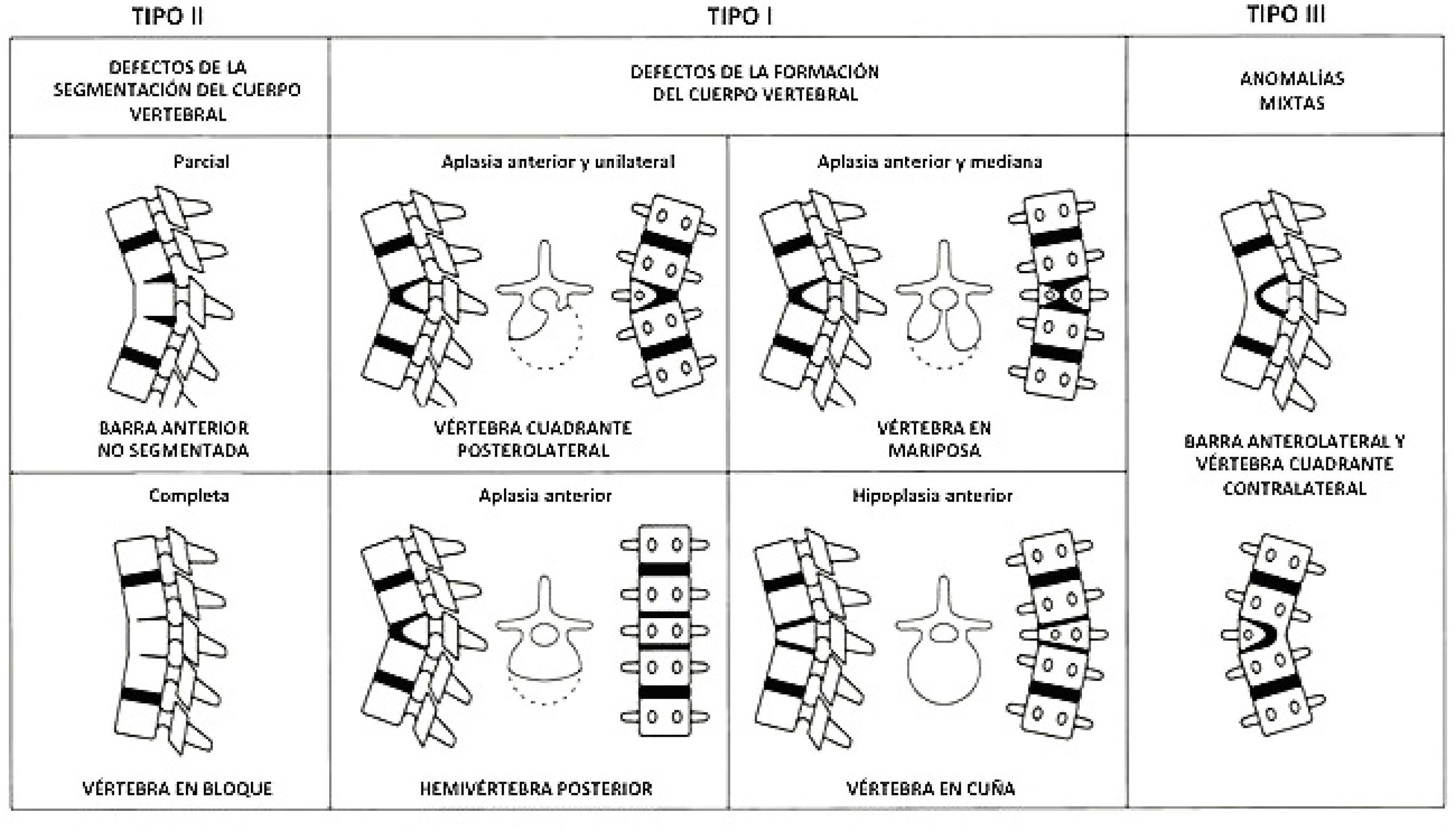 CIFOSIS PATOLÓGICA EN LA COLUMNA PEDIÁTRICA | Revista Médica Clínica ...
