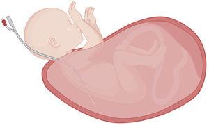 EX-UTERO INTRAPARTUM TREATMENT (EXIT) | Revista Médica Clínica Las Condes