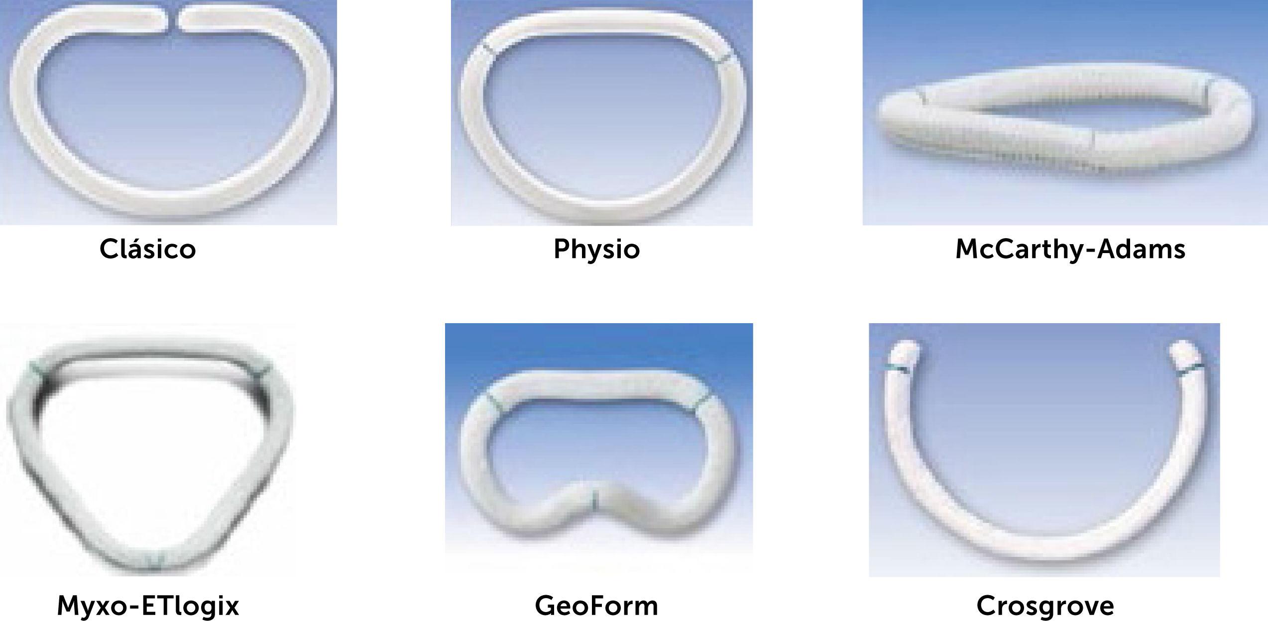 Cirugía reconstructiva de la insuficiencia valvular mitral | Revista ...
