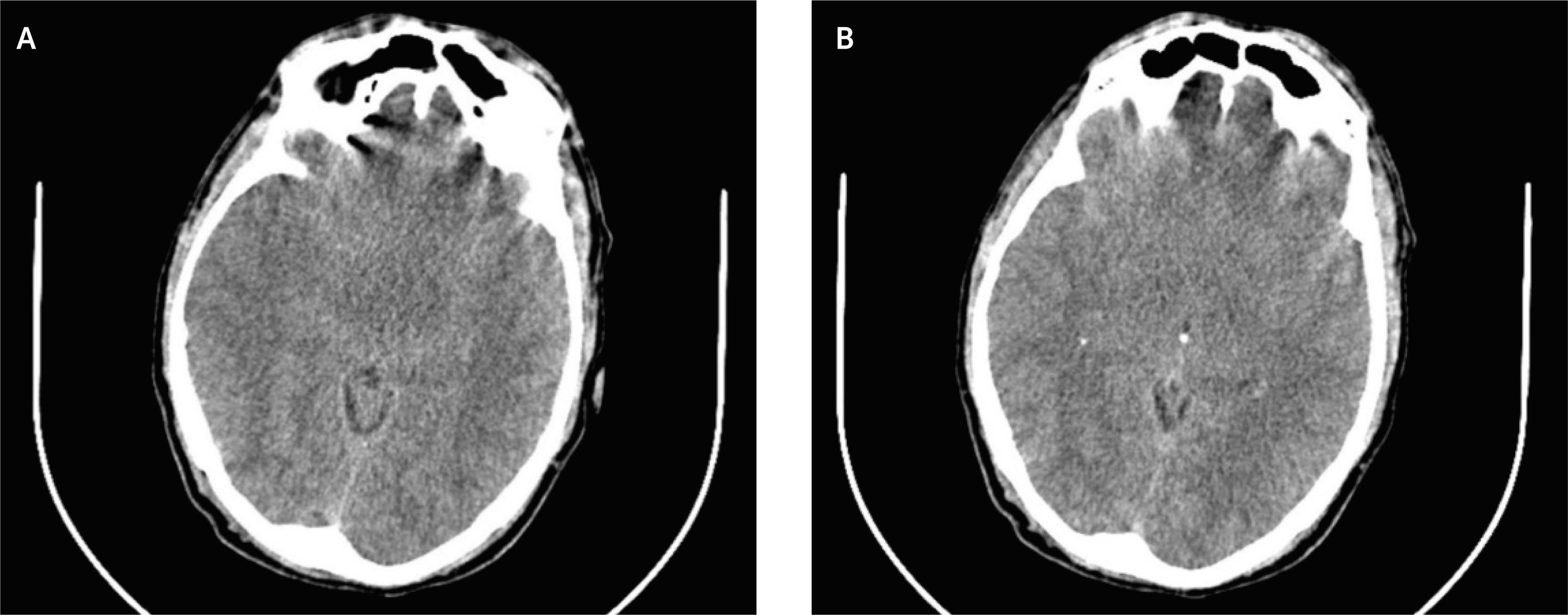 Mielitis transversa aguda como complicación de leptospirosis: reporte ...