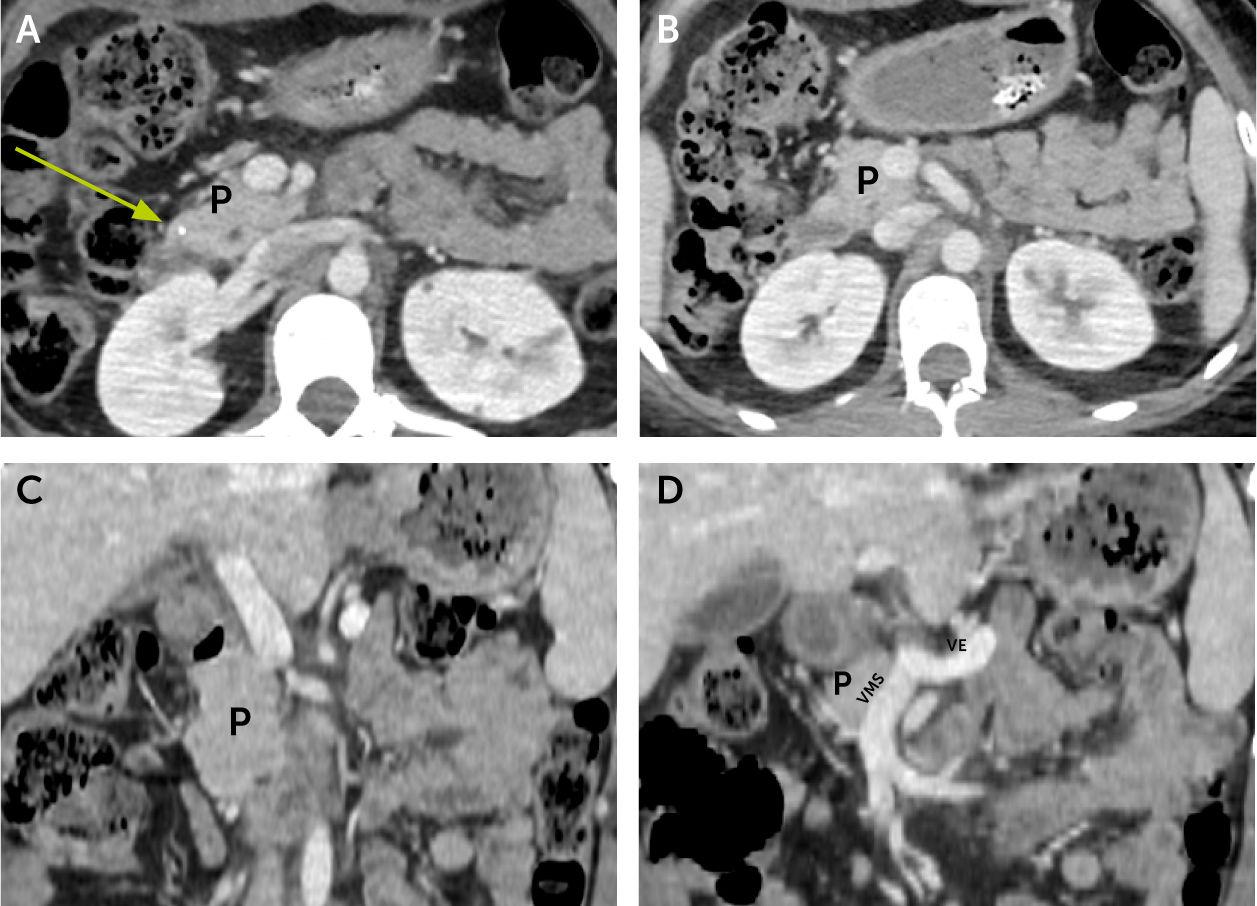 Agenesia del páncreas dorsal: reporte de caso y revisión del tema ...
