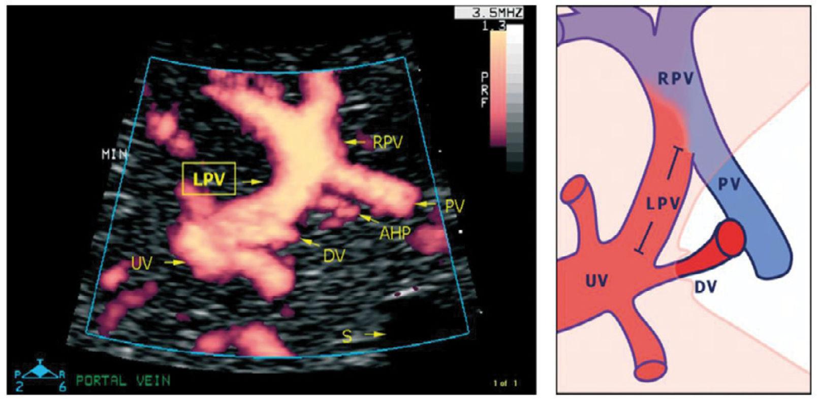 Diabetes mellitus impact on fetal liver circulation, and new diagnostic ...