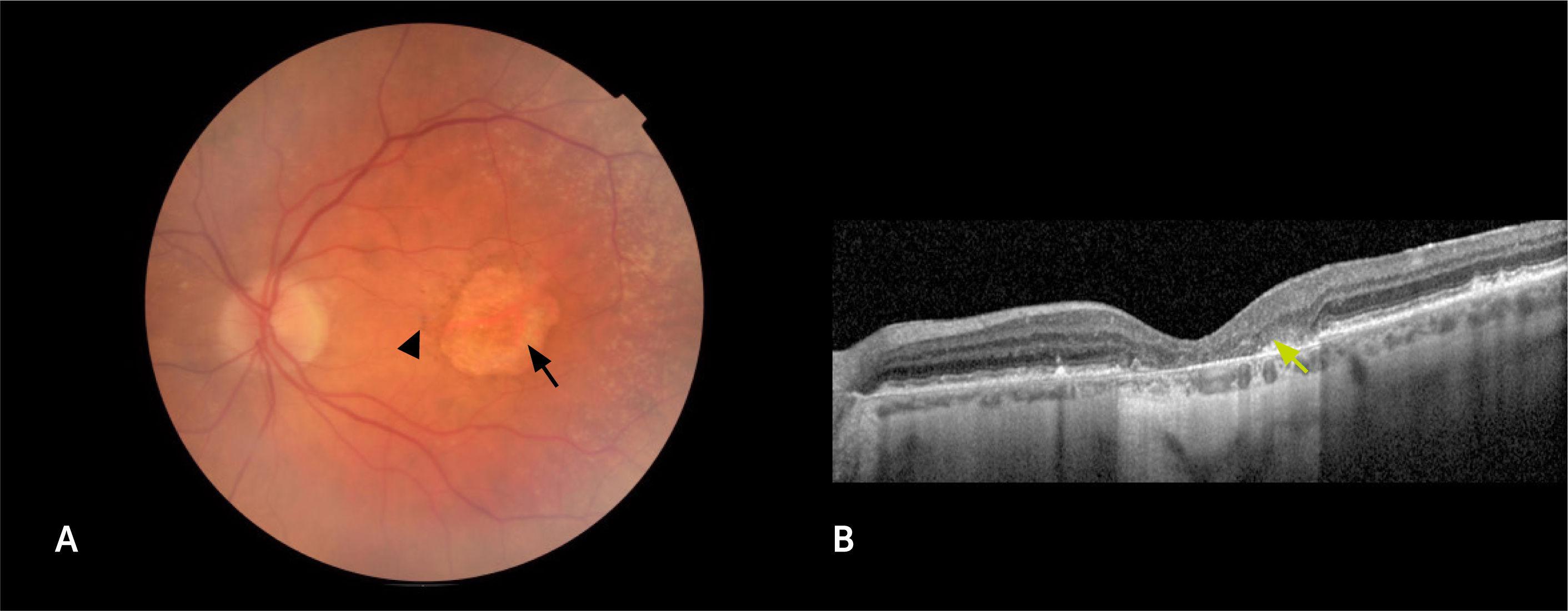 Tratamiento actual de la degeneración macular relacionada con la edad ...