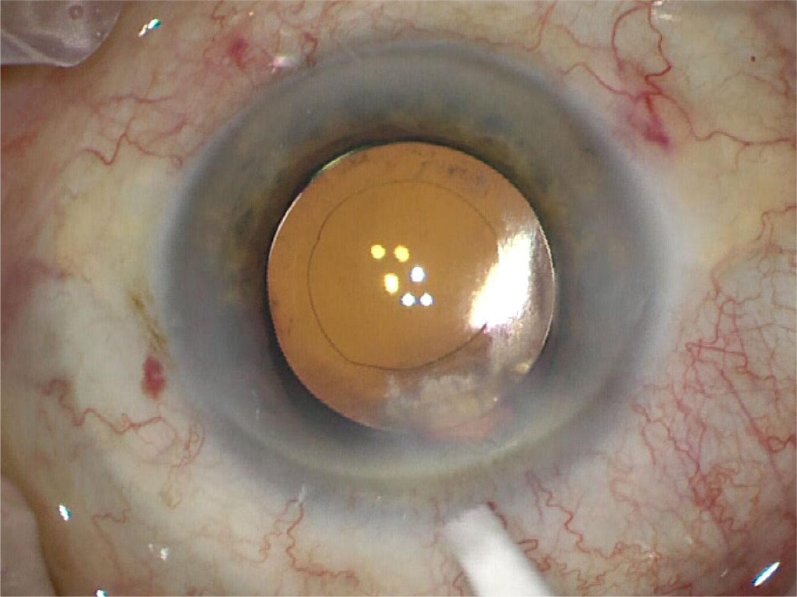 Cirugía de cataratas hoy: una actualización | Revista Médica Clínica ...