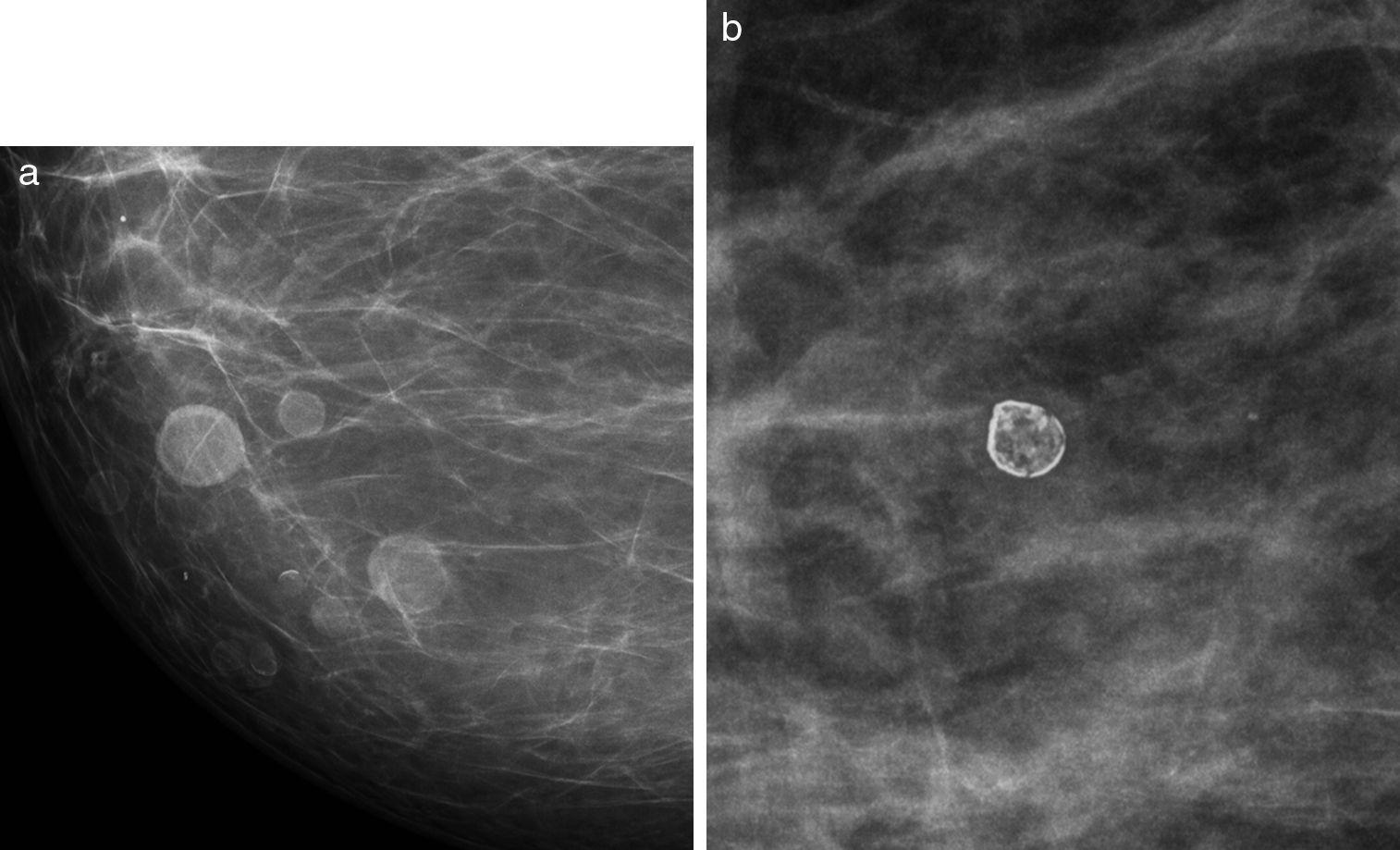 Calcificaciones mamarias: descripción y clasificación según la 5.a ...