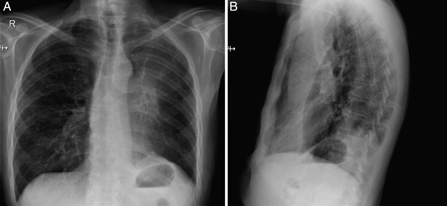 Signo radiológico: signo de Luftsichel | Revista Chilena de Radiología