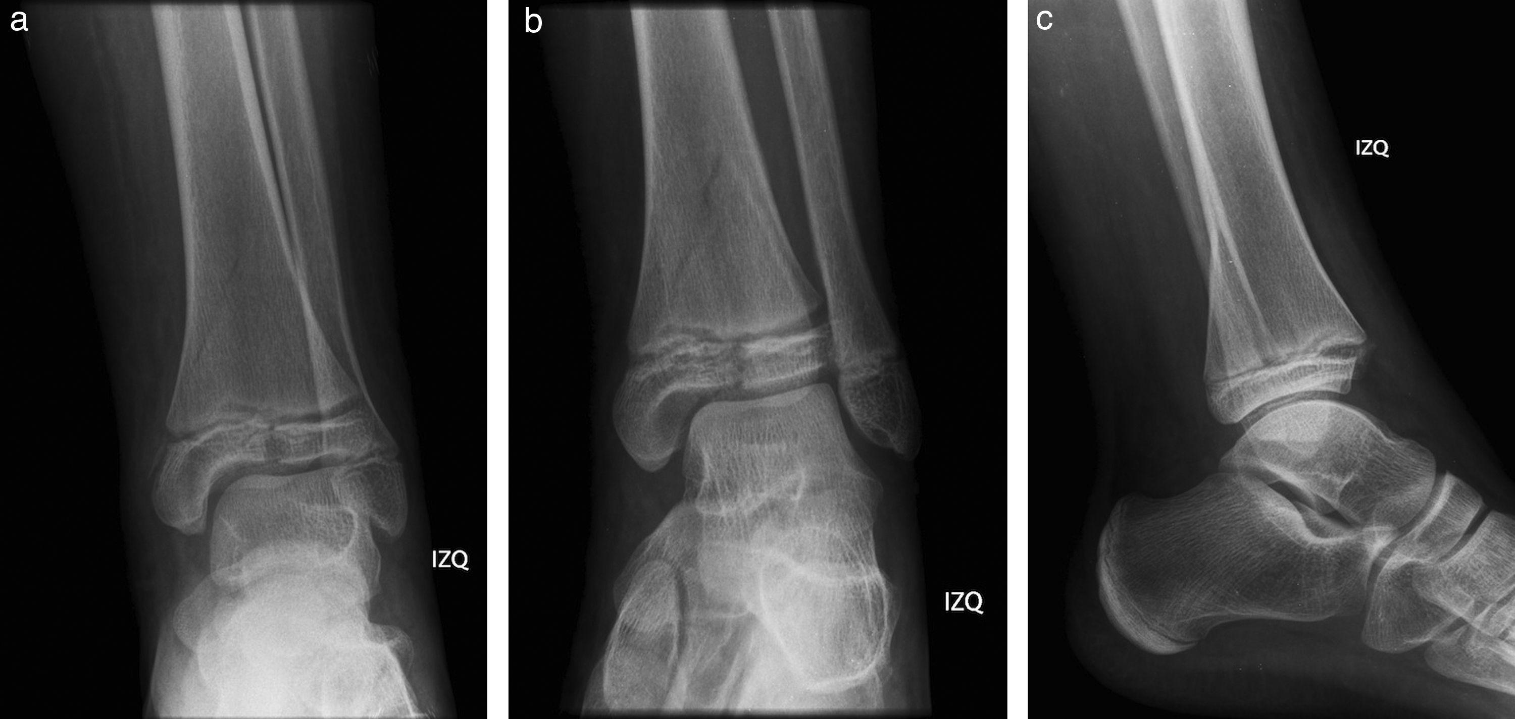 Comprendiendo las fracturas triplanares de la tibia distal | Revista ...