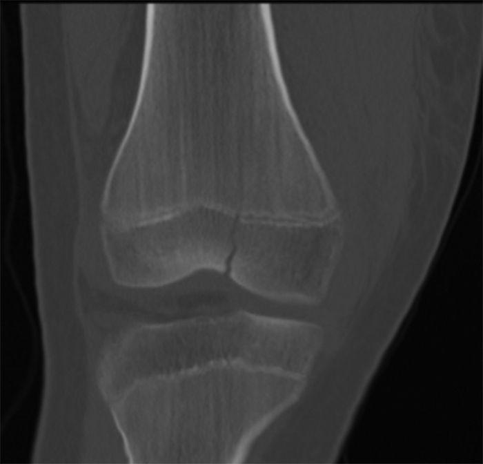 Lesiones y variantes normales de la rodilla pediátrica | Revista ...