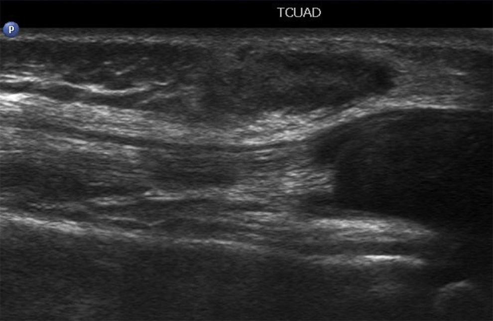 Lesiones y variantes normales de la rodilla pediátrica | Revista ...