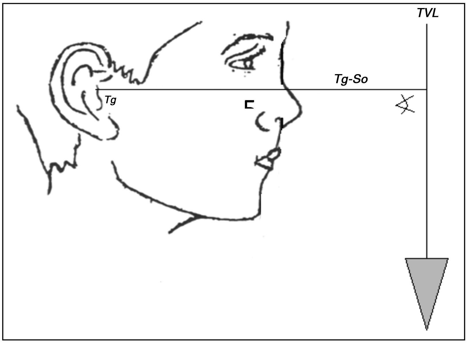Efecto del aumento de la dimensión vertical oclusal en la posición ...