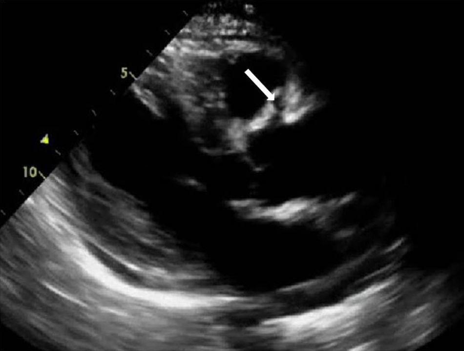 Imagem tubular «transversal ao septo interauricular» | Revista ...