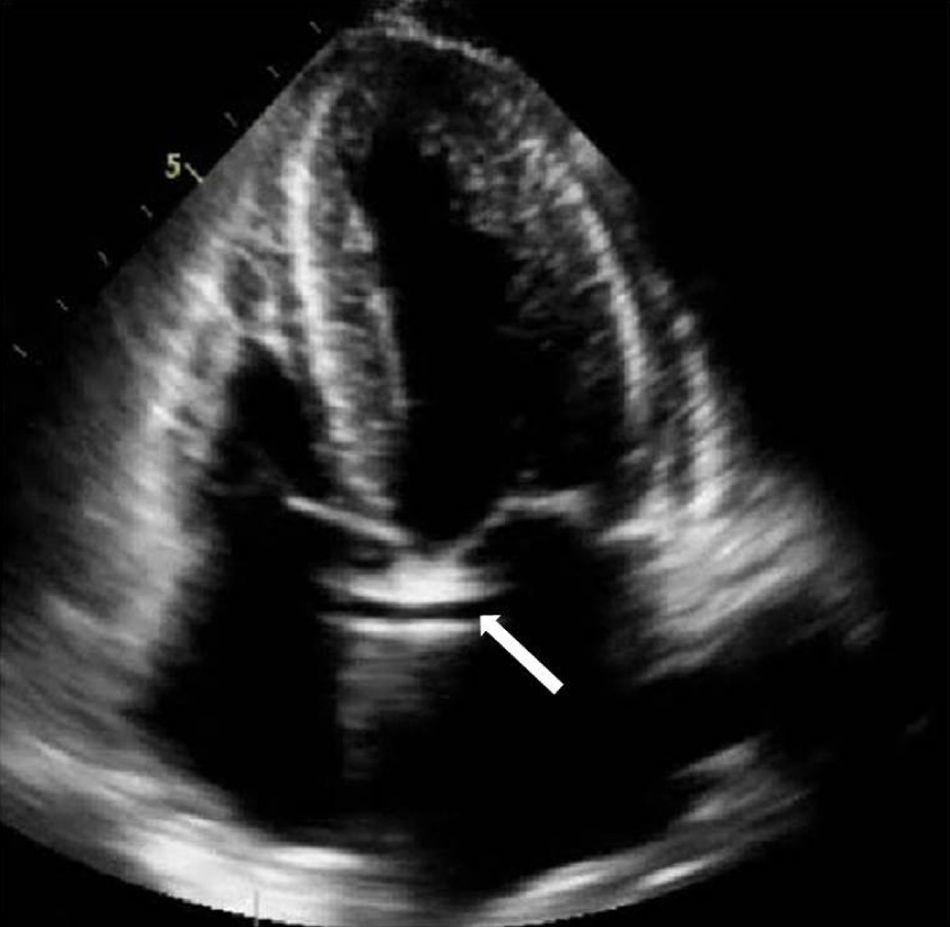 Imagem tubular «transversal ao septo interauricular» | Revista ...