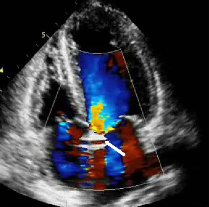 Imagem tubular «transversal ao septo interauricular» | Revista ...