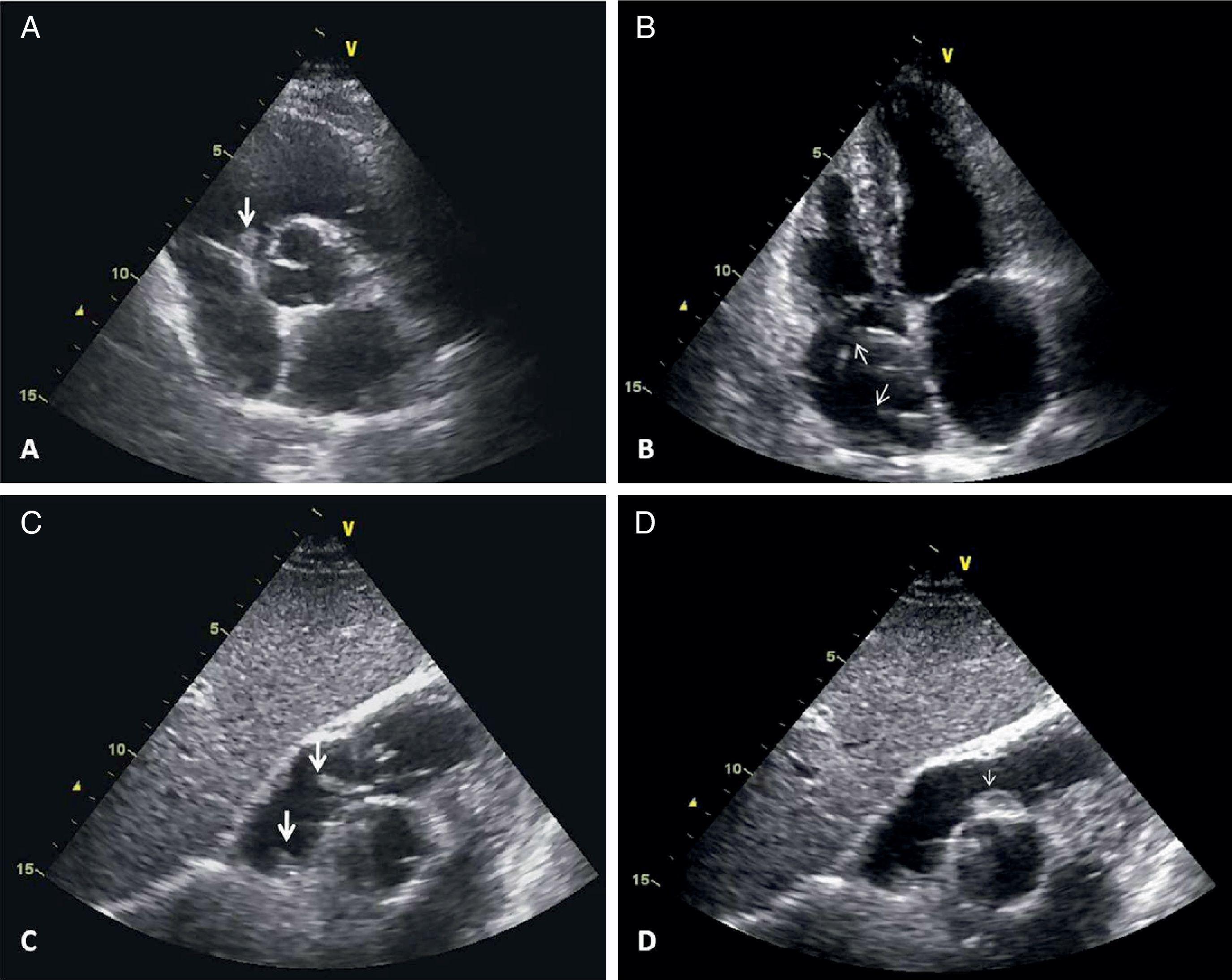 An unusual case of pacemaker endocarditis in a patient with ...