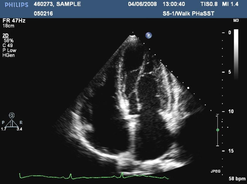 Anomalous insertion of the papillary muscle in a patient with sickle ...