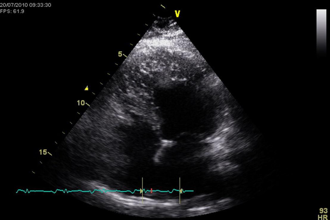 Embolic complication of left ventricular non-compaction as an unusual ...