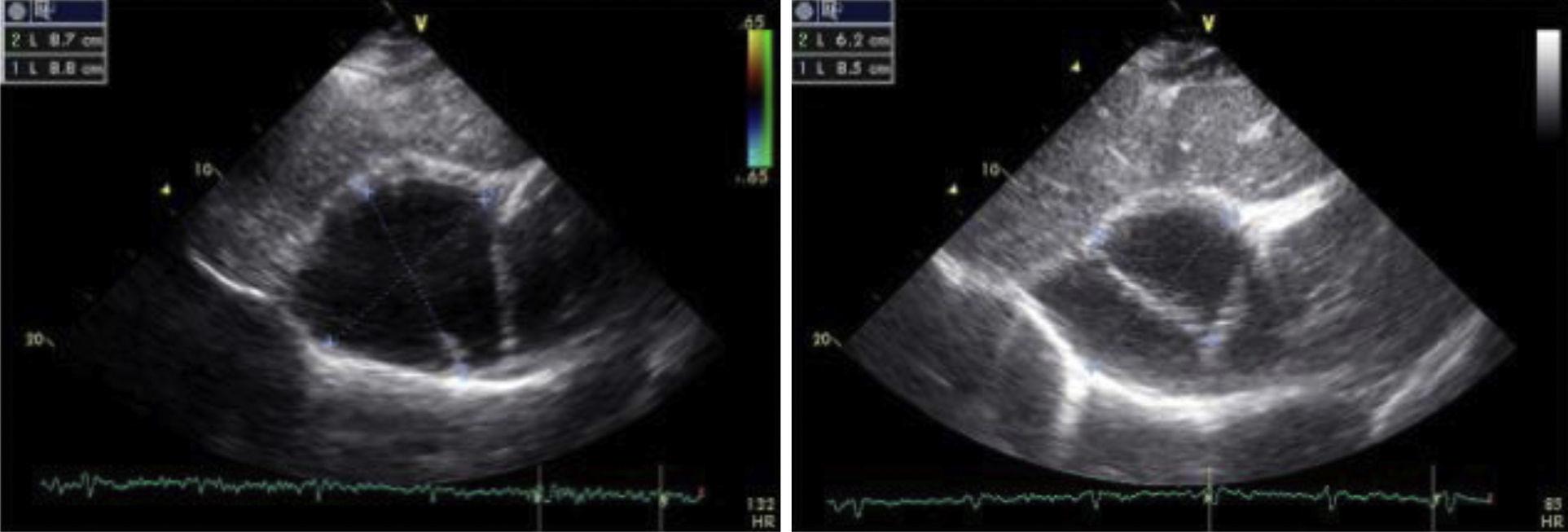 Giant pericardial cyst mimicking dextrocardia on chest X-ray | Revista ...