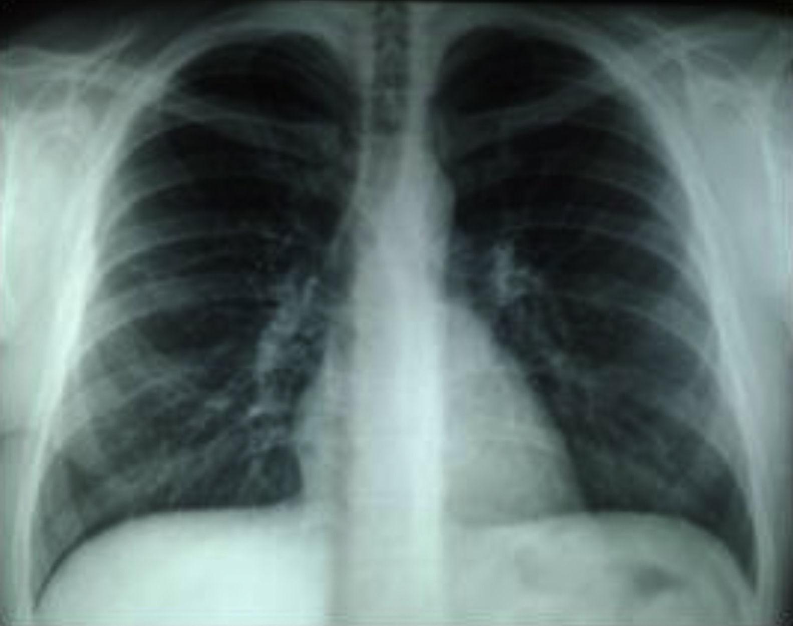 Giant pericardial cyst mimicking dextrocardia on chest X-ray | Revista ...