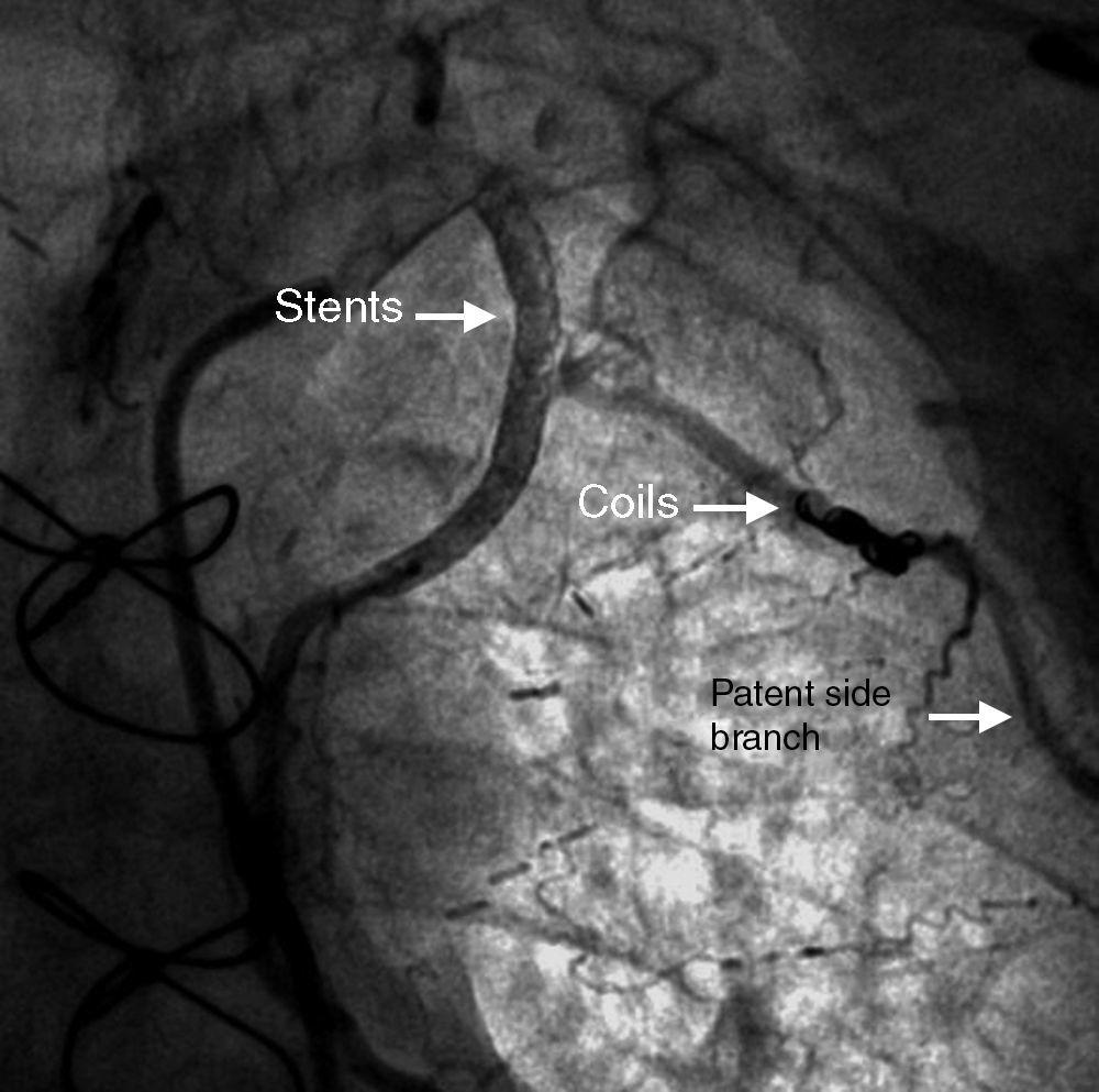 Ischemia induced by coronary steal through a patent mammary artery side ...