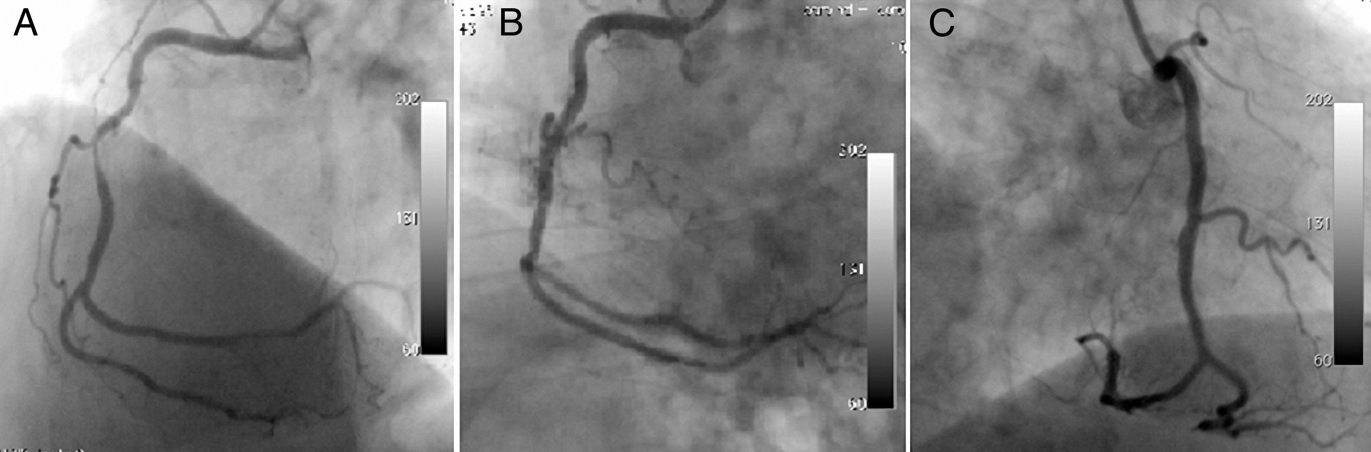 Coronary artery perforations: Four different cases and a review ...