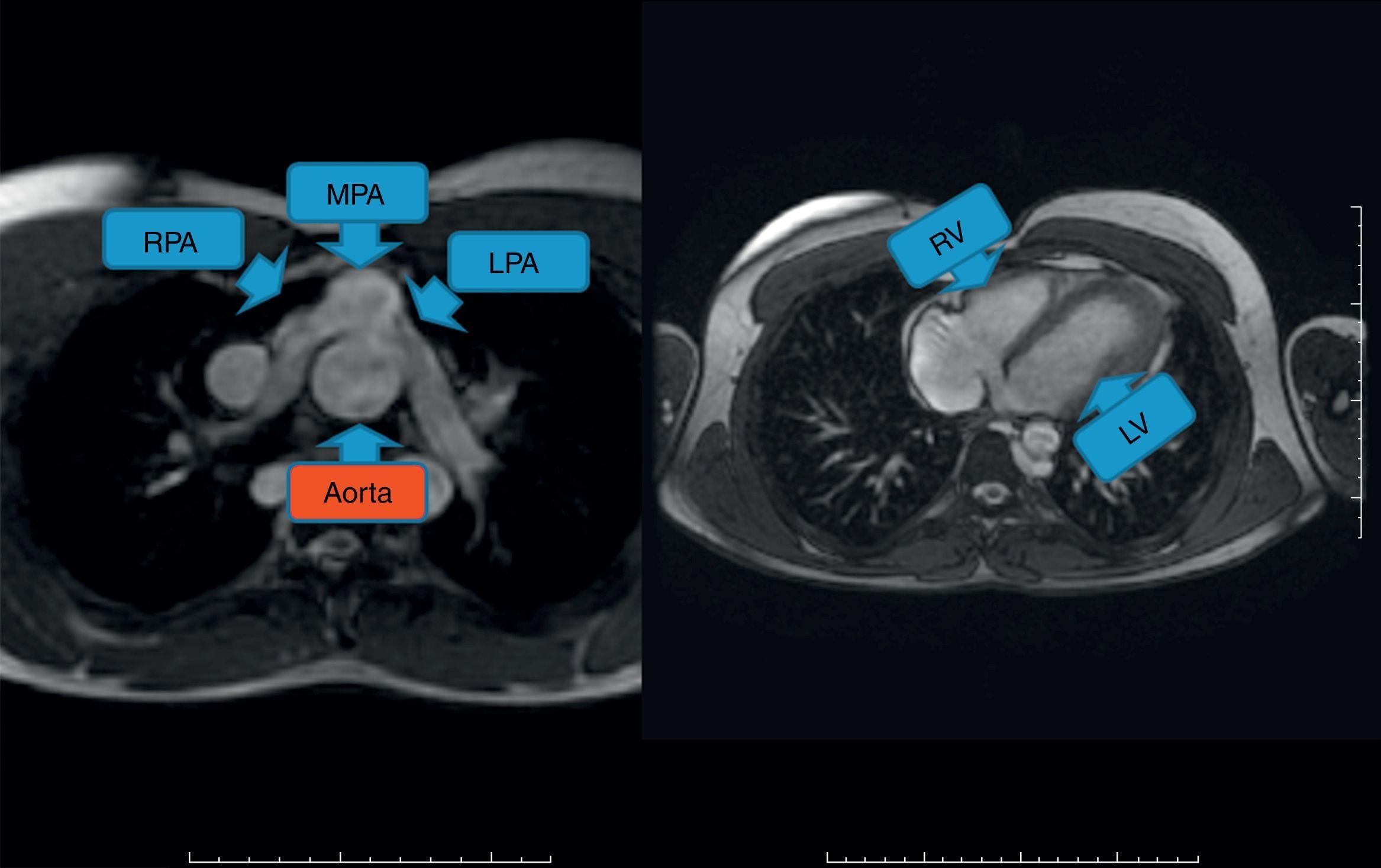 Transposition Of The Great Arteries X Ray