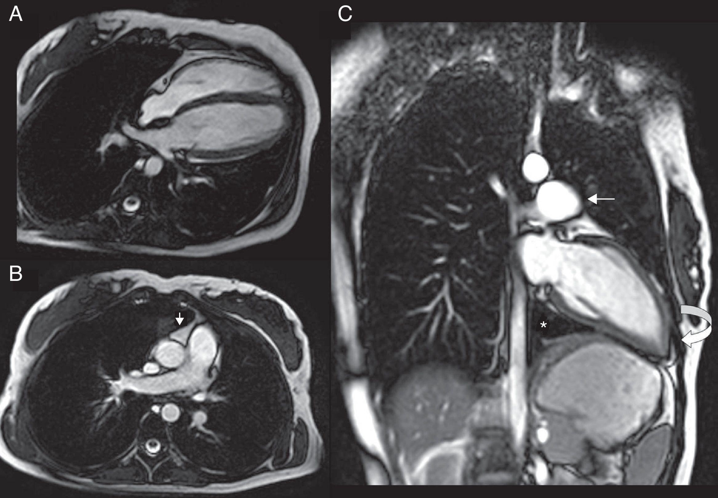 Congenital complete absence of pericardium in a young woman with non ...