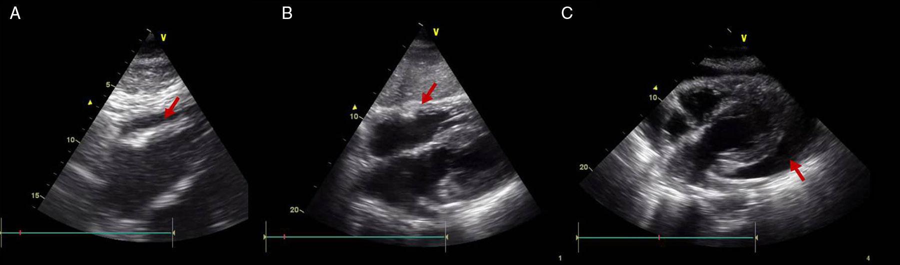 Post-cardiac injury syndrome following transvenous pacing: Case report ...