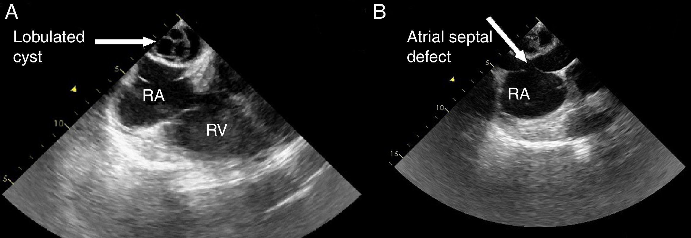 Mediastinal hydatid cyst compressing the pulmonary artery and atrial ...