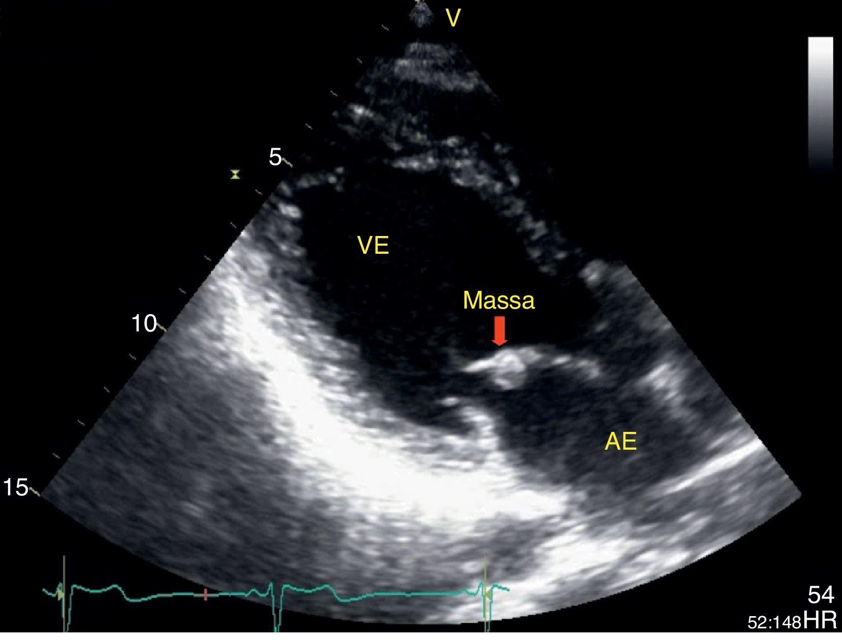 Fibroelastoma ou mixoma, eis a questão? | Revista Portuguesa de Cardiologia