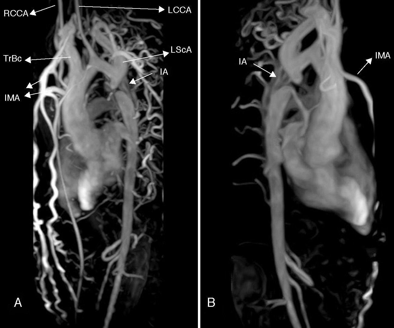 Assessment of interrupted aortic arch with magnetic resonance ...