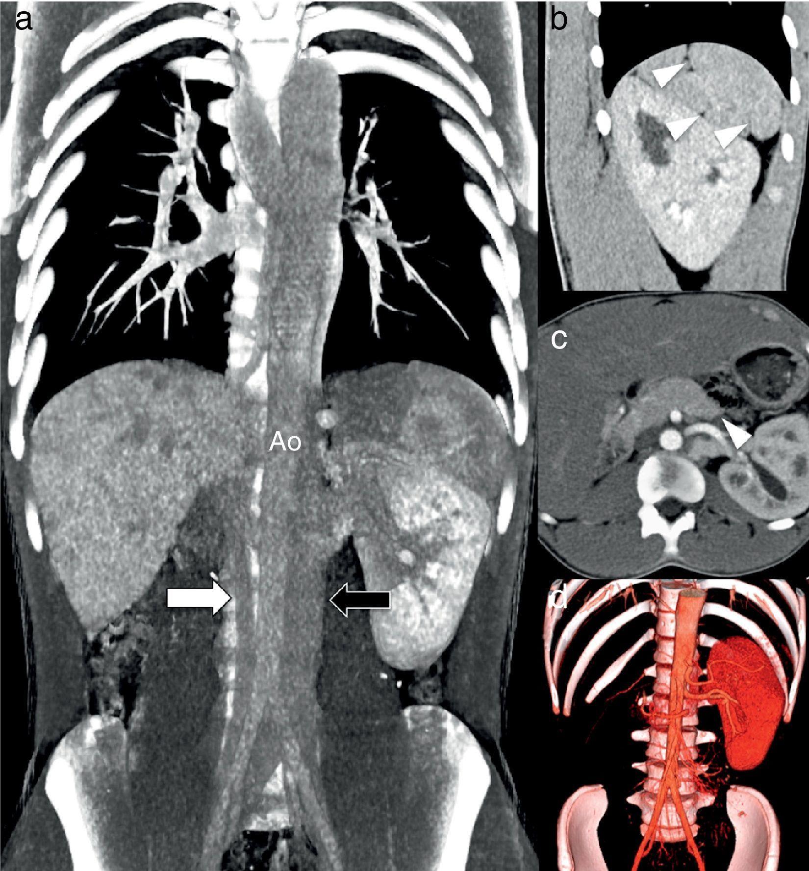 Aortic pseudocoarctation associated with polysplenia/heterotaxy ...