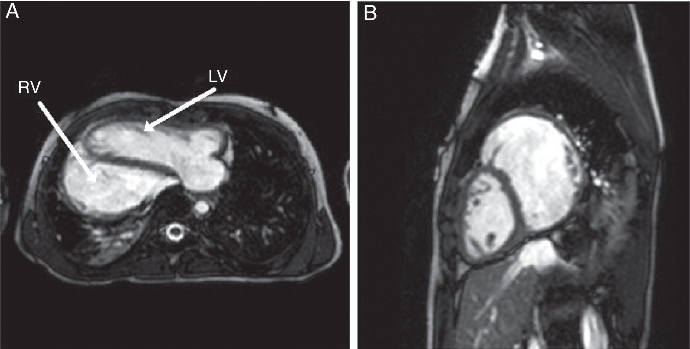 Juxtaposed right atrial appendage in complex Transposition of the Great ...