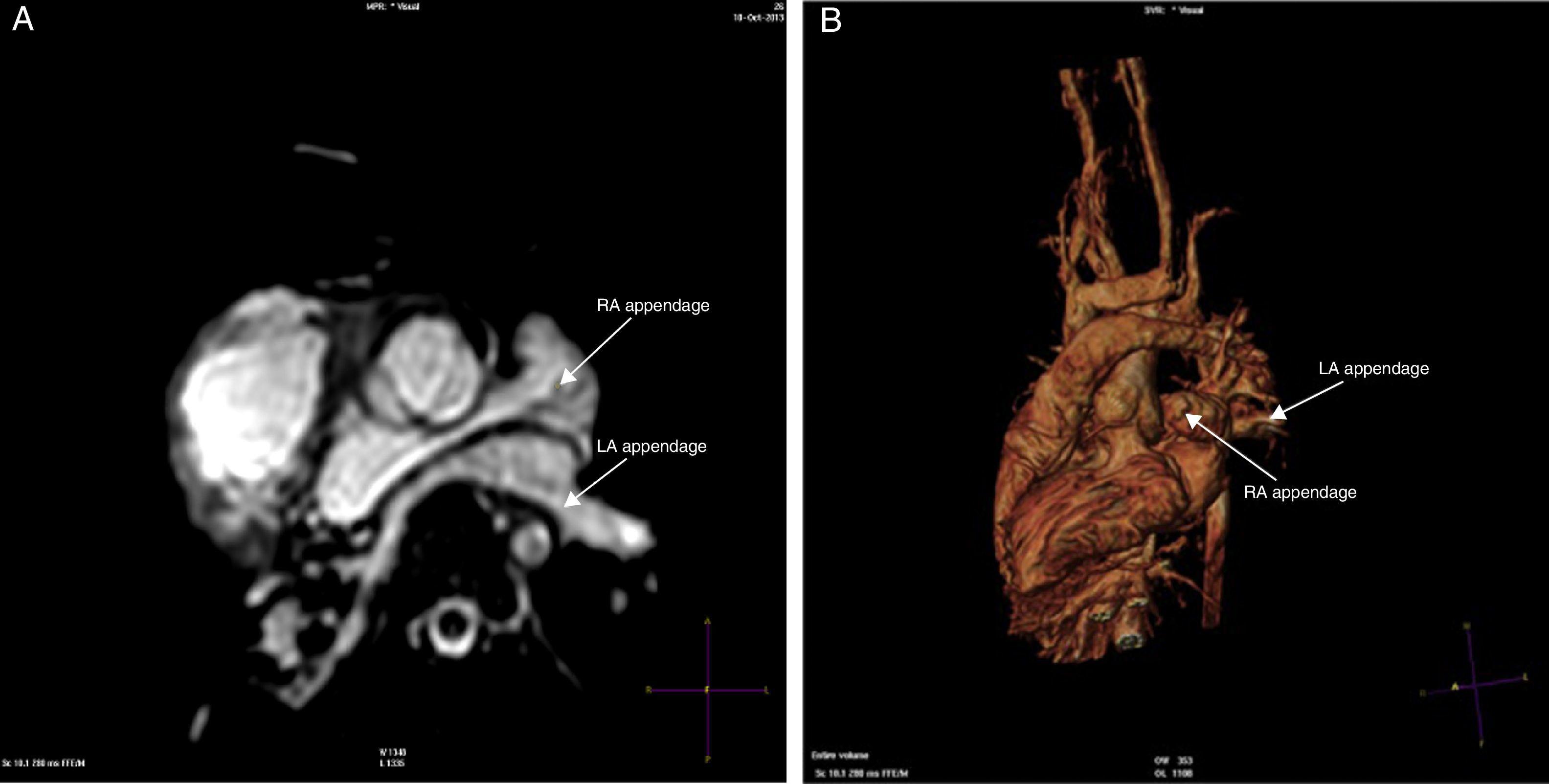 Juxtaposed right atrial appendage in complex Transposition of the Great ...