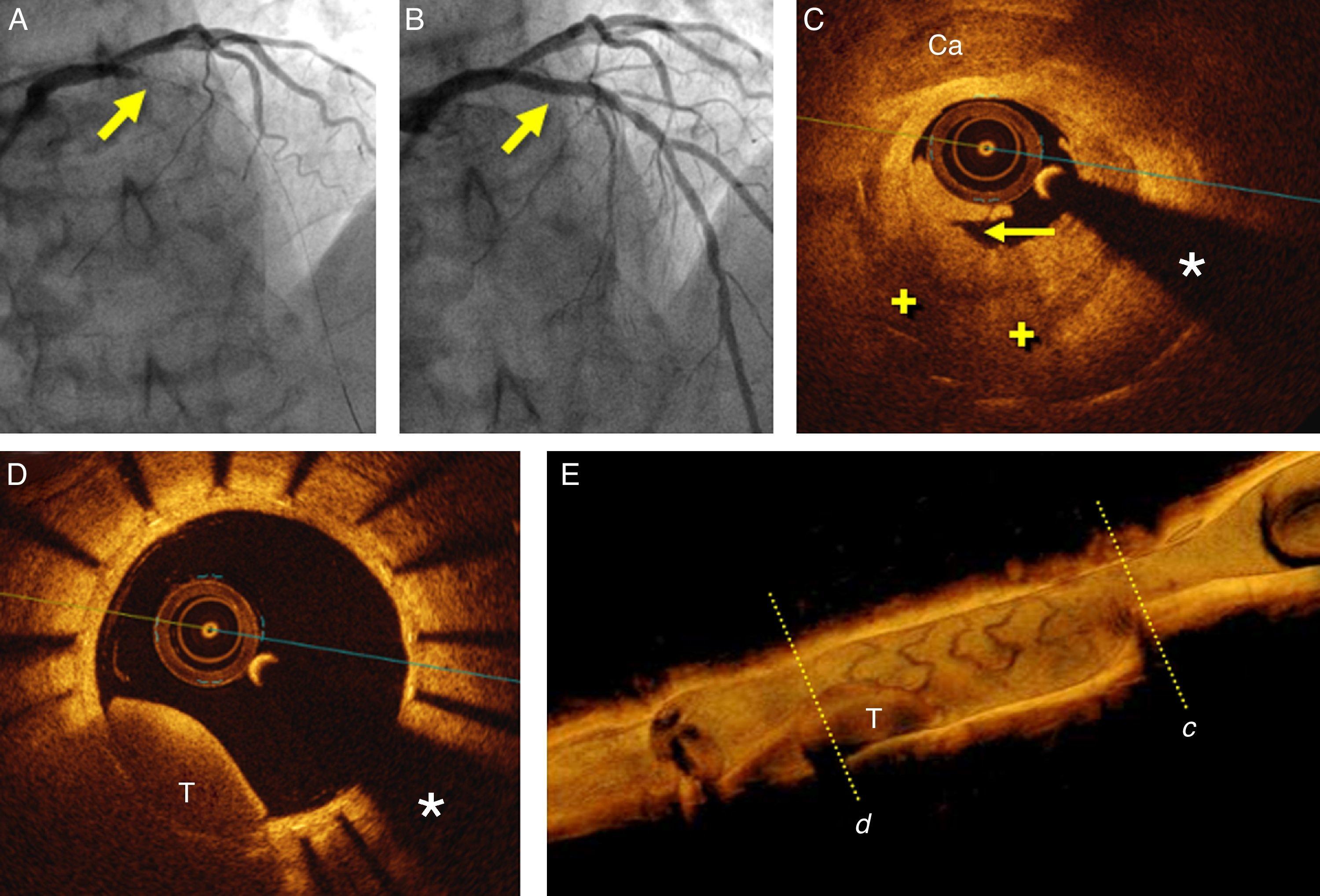 Bioresorbable vascular scaffold for very late stent thrombosis ...