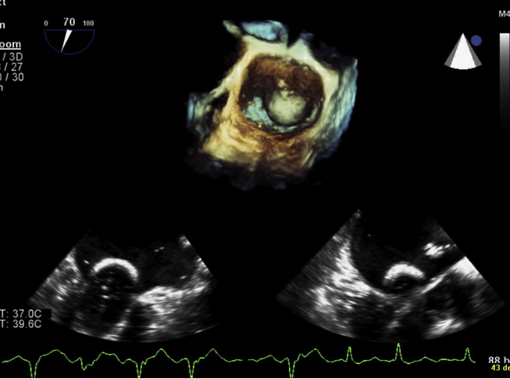 Percutaneous balloon mitral valvuloplasty and closure of the left ...