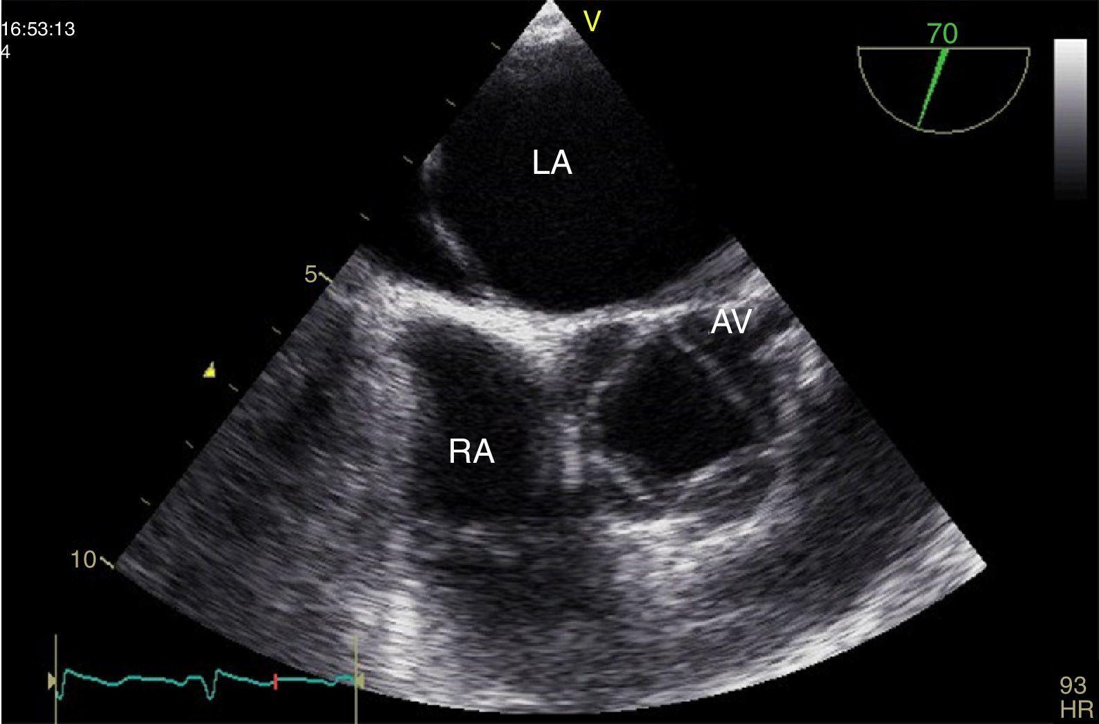 Unexpected diagnosis in a liver donor candidate | Revista Portuguesa de ...