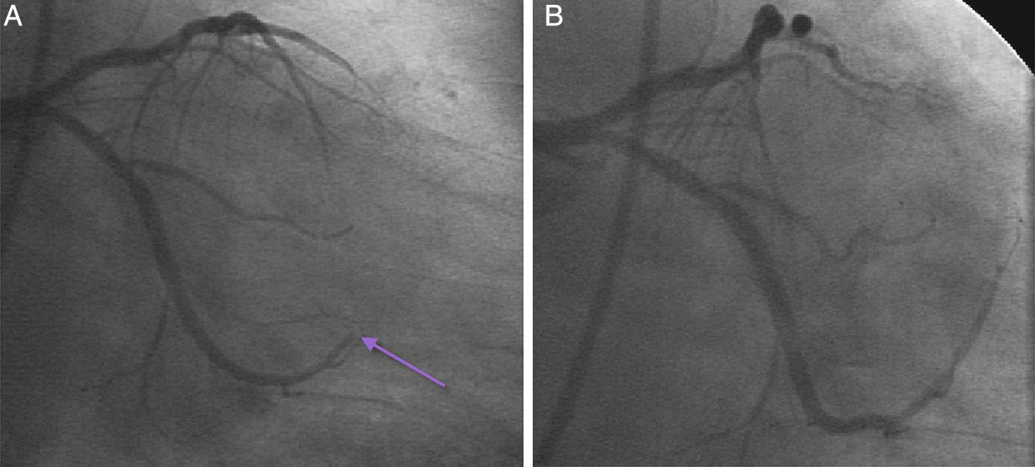Acute myocardial infarction caused by left atrial myxoma: Role of ...