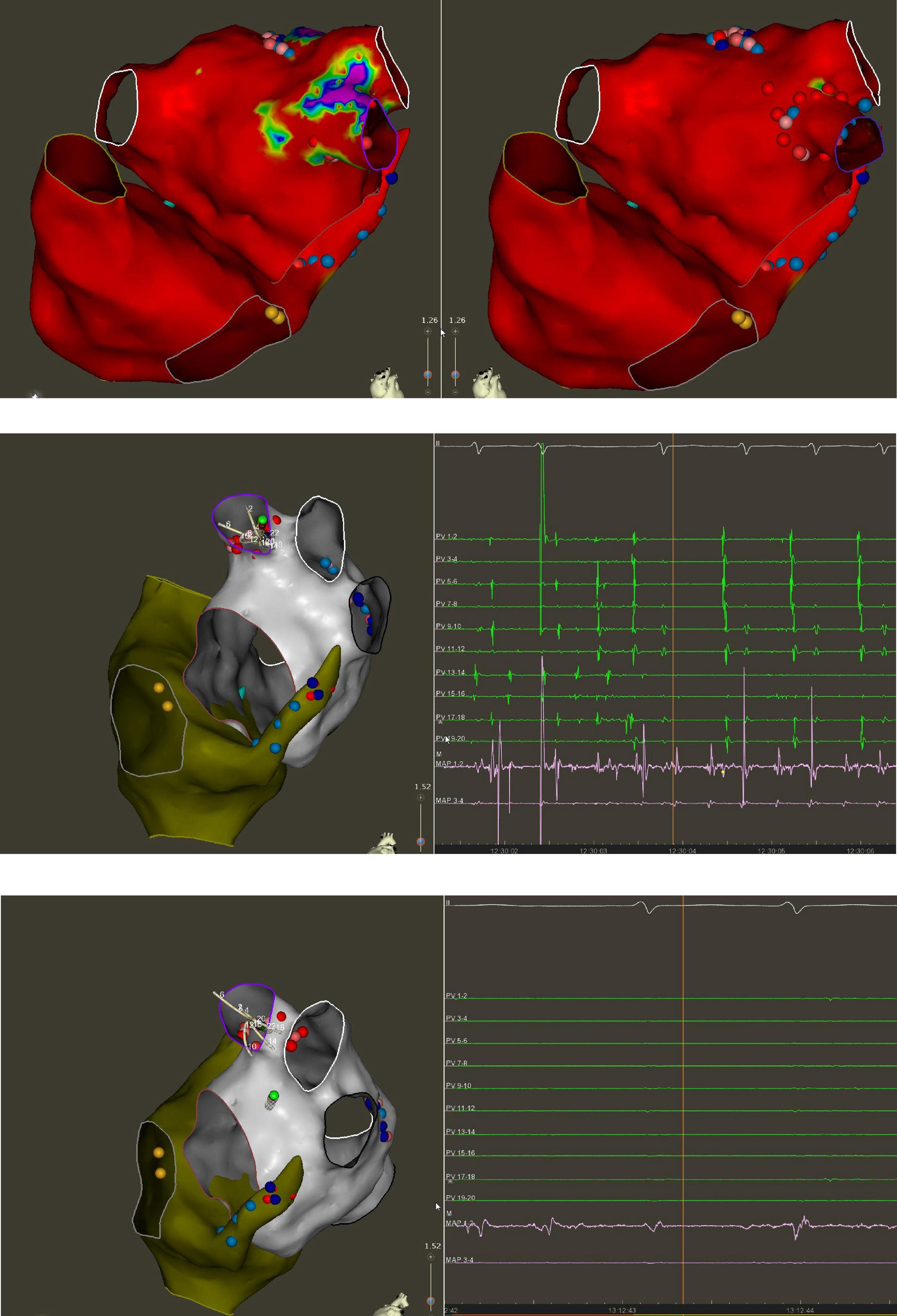 Atrial fibrillation ablation beyond pulmonary veins: The role of left ...