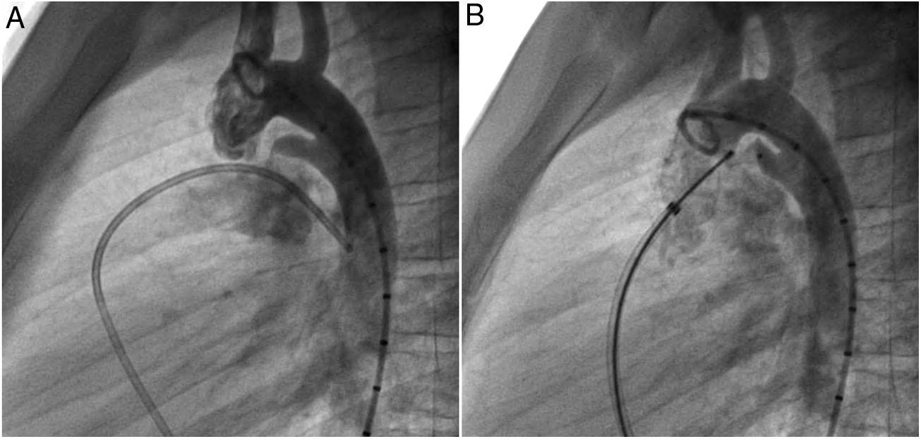 Percutaneous patent ductus arteriosus closure: Twelve years of ...