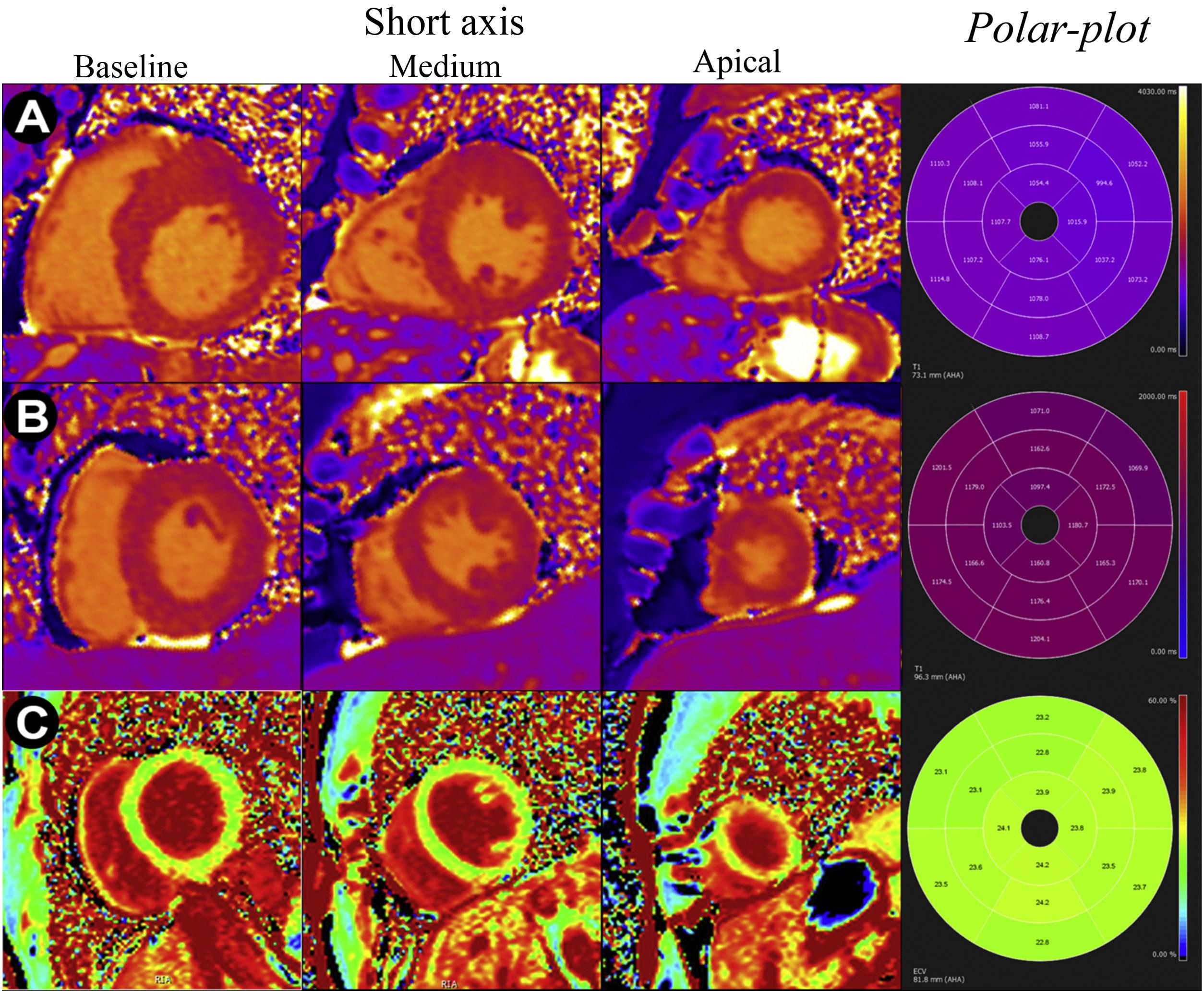 Myocardial T1 mapping with magnetic resonance imaging – a useful tool ...