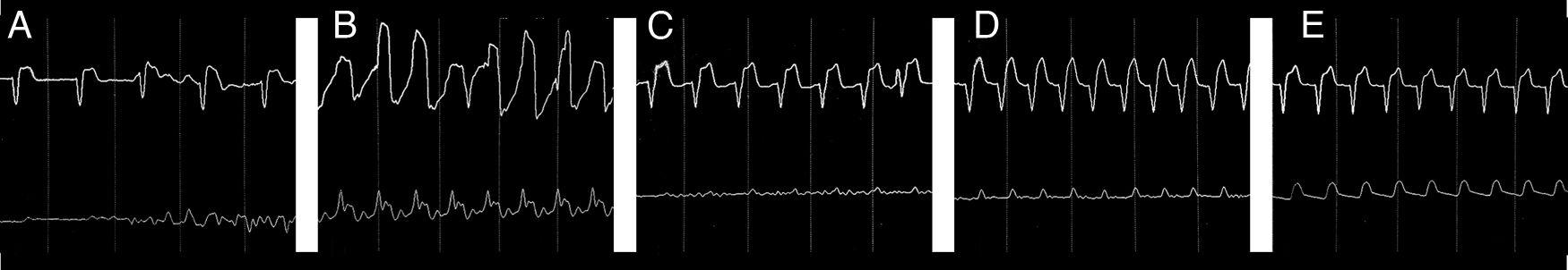Arterial waveform during extracorporeal cardiopulmonary resuscitation ...